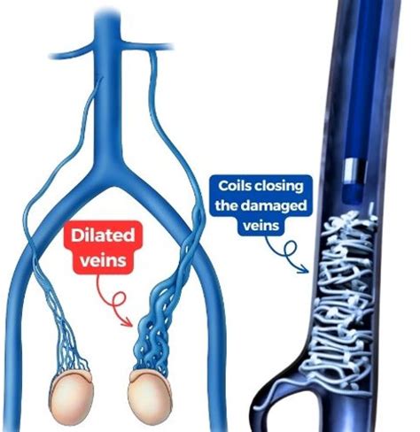 Varicocele Embolization No Surgery Drnagateja