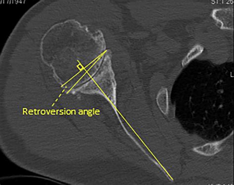 Retroversion Angle Measured Between The Longitudinal Axis Of The