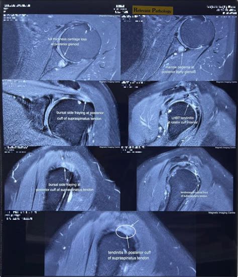 Paula Fernanda Swanson On Linkedin Acupuncture Help To Resolve The Calcific Deposits Of A