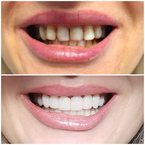 Flow Injection Bella Clinica