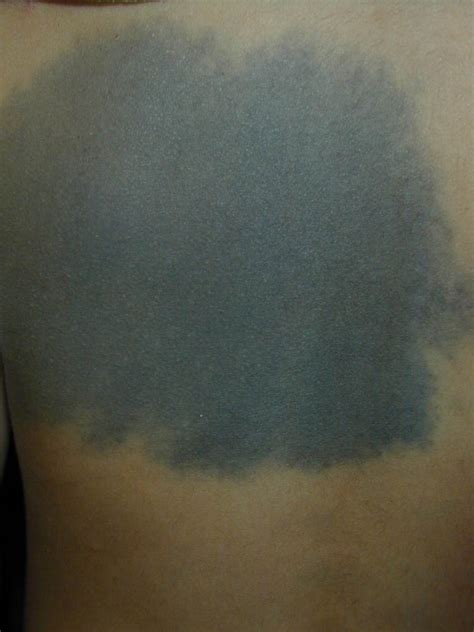 Melanocytic Nevi