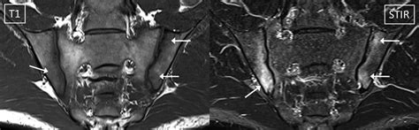 Sacroiliitis Mri Sacroiliitis Differential Leo Löwchen