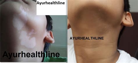 Vitiligo Herbal Treatment Herbal Skin Care Solutions Ayurhealthline