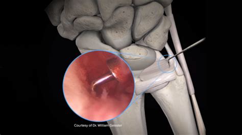 Triangular Fibrocartilage Complex Tfcc Injuries Orthopedia Academics