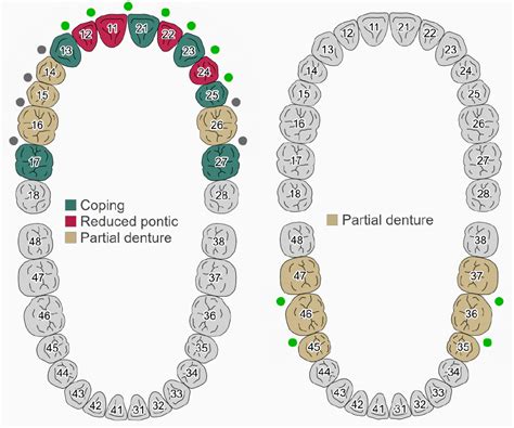 Partial Framework Design Exocad