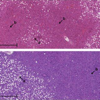 Spatial Heterogeneity Of Steatosis Steatotic Areas A And