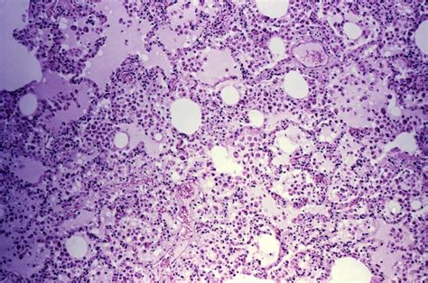 Free Picture Histopathologic Detected Lung Biopsy Tissue Section Marburg Patient
