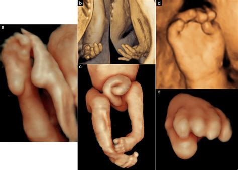 Congenital Hypotonia Systematic Approach For Prenatal Detection Weissbach 2023 Ultrasound