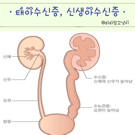 태아 수신증 신생아 수신증 원인 및 치료방법 추천병원