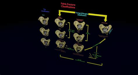 Pelvis Fracture Classifications 3d Model Superhive Formerly Blender