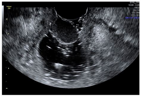 The Application Of Sonovaginography For Implementing Ultrasound
