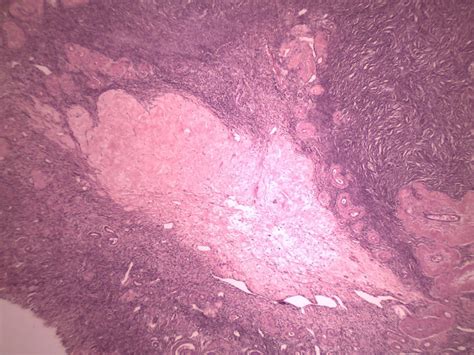 Corpus Albicans
