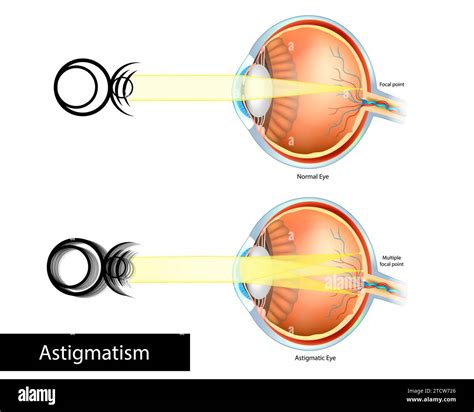 Astigmatism Vs Normal Vision Understanding The Differences