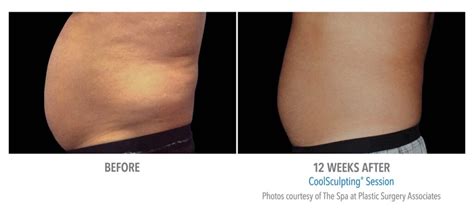The Coolsculpting Elite Procedure What To Expect During Your Treatment
