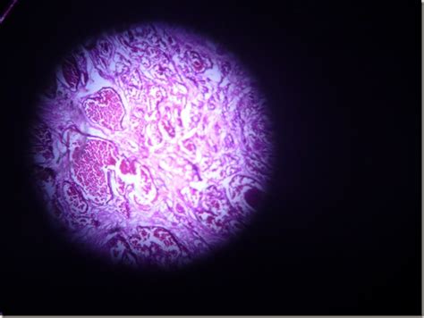 Histology Slides Database Cavernous Hemangioma Histopathology