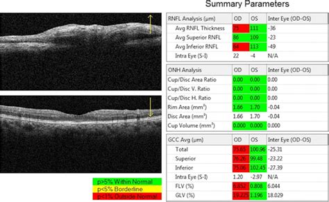 RTVue 100 OCT Analysed The Optic Nerve Head Imaging In The Optic Disc Download Scientific