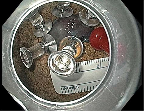 Resected Tumor From The Upper Esophageal Sphincter And Piriform Sinus Download Scientific Diagram