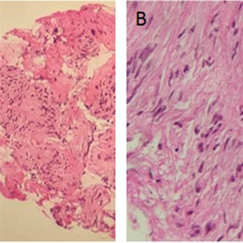 A Histological Appearance Of A Gastric Gist In A 66 Year Old Patient