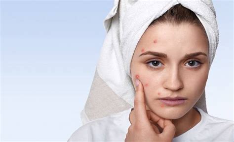 Vanquish Pimples Top Tactics Revealed