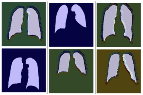 Tssg Cnn A Tuberculosis Semantic Segmentation Guided Model For Detecting And Diagnosis Using