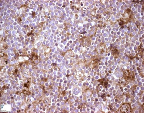 Nodal Burkitt Lymphoma Human Pathology