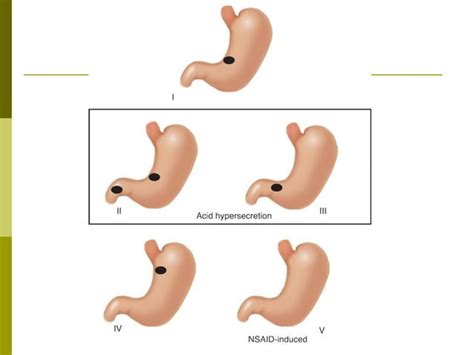 Peptic Ulcer Disease Pptx Duodenum Ulcer Ppt Free Download