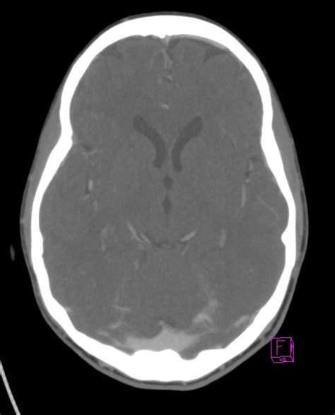Normal Ct Brain And Venogram Radiopaedia 28100 28356 Axial C Delayed