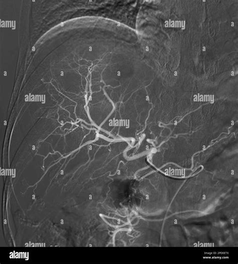 Imaging Of Tace Or Chemoembolization Is A Procedure That Allows A Dose Of Chemotherapy Drugs To Imaging Of Tace Or Chemoembolization Is A Procedure That Allows A Dose Of Chemotherapy Drugs To