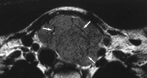 Ectopic Cervical Thymoma Mri Findings Ajr