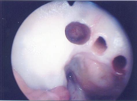 Harvesting Above The Intercondylar Notch Private Photography