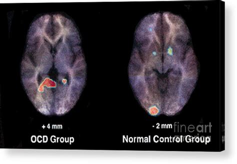 Ocd Brain Graphics Ocd And Adhd Comorbid Symptoms And Treatment