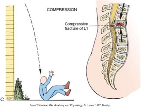 Spinal Cord Compression ME Flashcards Quizlet