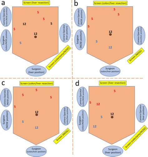 Simultaneous Laparoscopic Colectomy And Liver Metastasectomy With