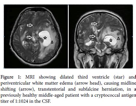 Cryptococcus Brain