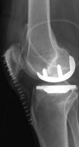 Die Knie Teilprothese Schlittenprothese Schulthess Klinik