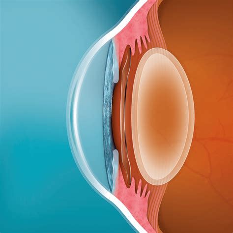 Evo Icl Eye Surgery Evo Implantable Collamer Lens