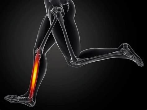 Beat Shin Splints Runner S World