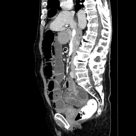 File Small Bowel Volvulus Causing Small Bowel Obstruction Mimicking Intussusception