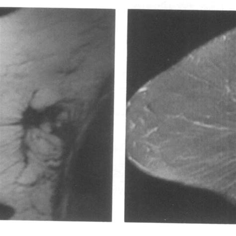 Benign Post Surgical Scar Spiculated Density On A Mammogram And B