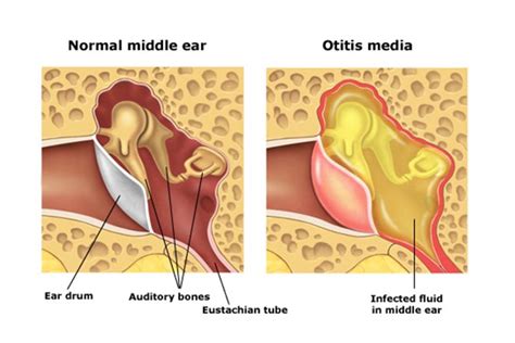 Prevent Ear Infections From Headphones Myths Risks And Tips