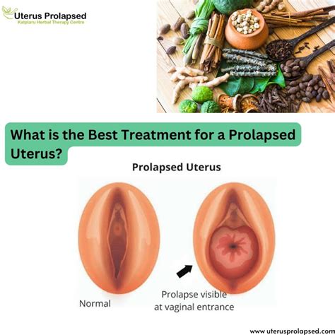 What Is The Best Treatment For A Prolapsed Uterus