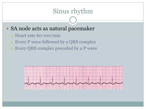 Interpretation Of Common Ecg Abnormalities PPTX