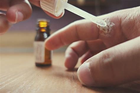 5 Pilihan Obat Kutil Paling Manjur Wisatasia