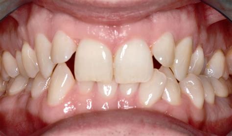 Two Stage Treatment Of Distal Occlusion With Help Of Orthodontic Appliance “herix” And Self