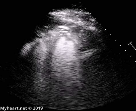 Women And Stress Cardiomyopathy Or Takotsubo • Myheart