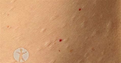 Anetoderma Image