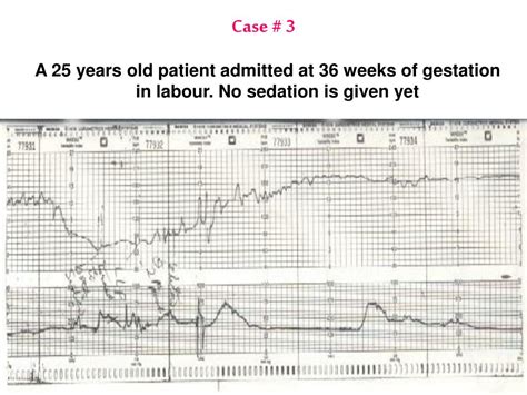 Ppt Intrapartum Ctg Workshop Powerpoint Presentation Free Download