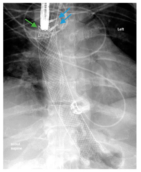 Endoscopic Management Of Post Sleeve Gastrectomy Complications