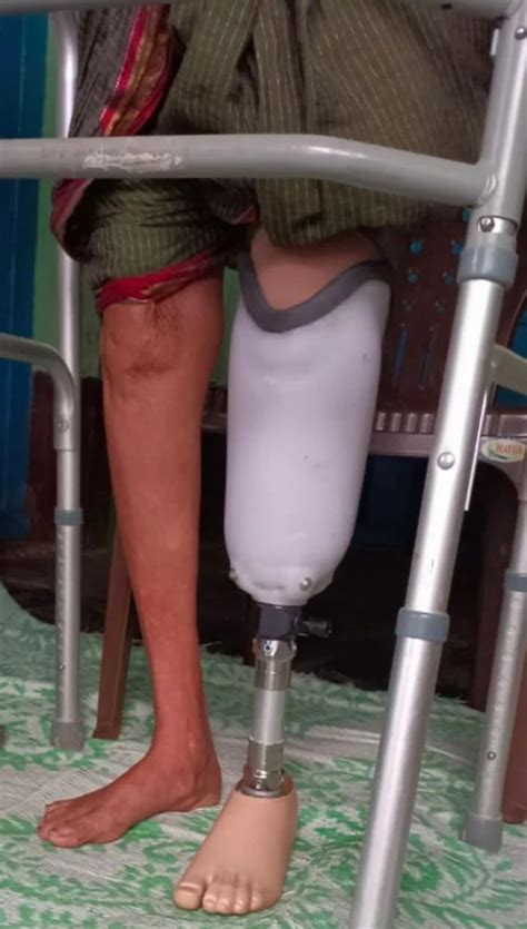 Below Knee Prosthesis Below Knee Prosthesis Trader Retailer From Surat