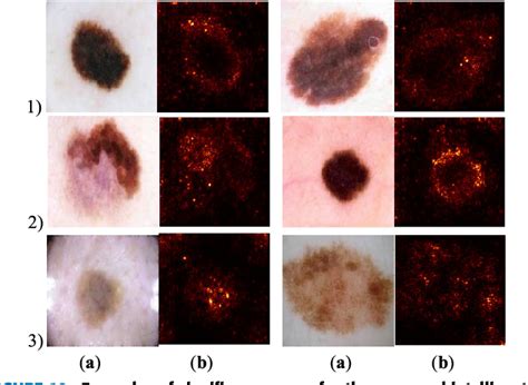 Figure 1 From Multimodal Analysis Of Unbalanced Dermatological Data For Skin Cancer Recognition